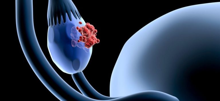 Ciste na jajnicima, simptomi, dijagnostika i liječenje | Poliklinika Fleur